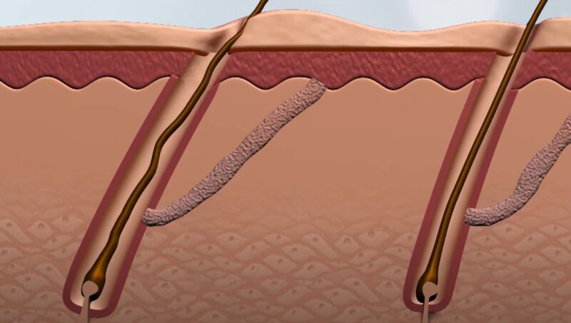 Can Creatine Really Cause Acne? What Does Science Say - Hills County Health